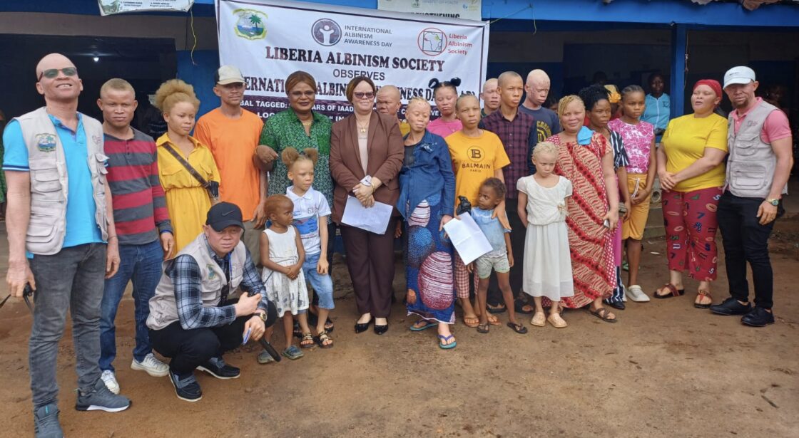 Liberia Albino Society Celebrates 10th International Albinism Awareness ...